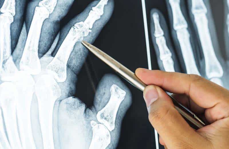 Și dinozaurii sufereau fracturi de stres - fracturi de oboseală | PortalMed