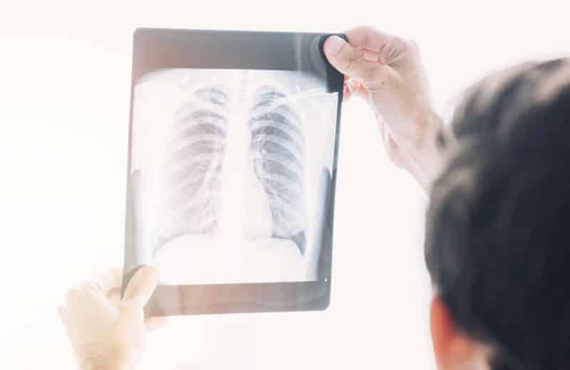 Tuberculoza pulmonară - Cum se transmite tuberculoza? | PortalMed